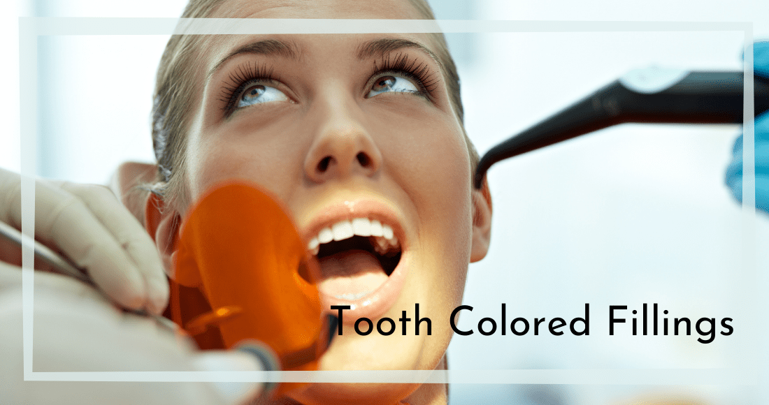 Tooth-Colored Fillings | Plano Dentist Dr Fred Haight